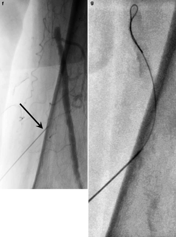 Distal Superficial Femoral Artery (SFA) Access | SpringerLink