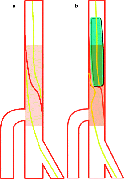Distal Superficial Femoral Artery (SFA) Access | SpringerLink