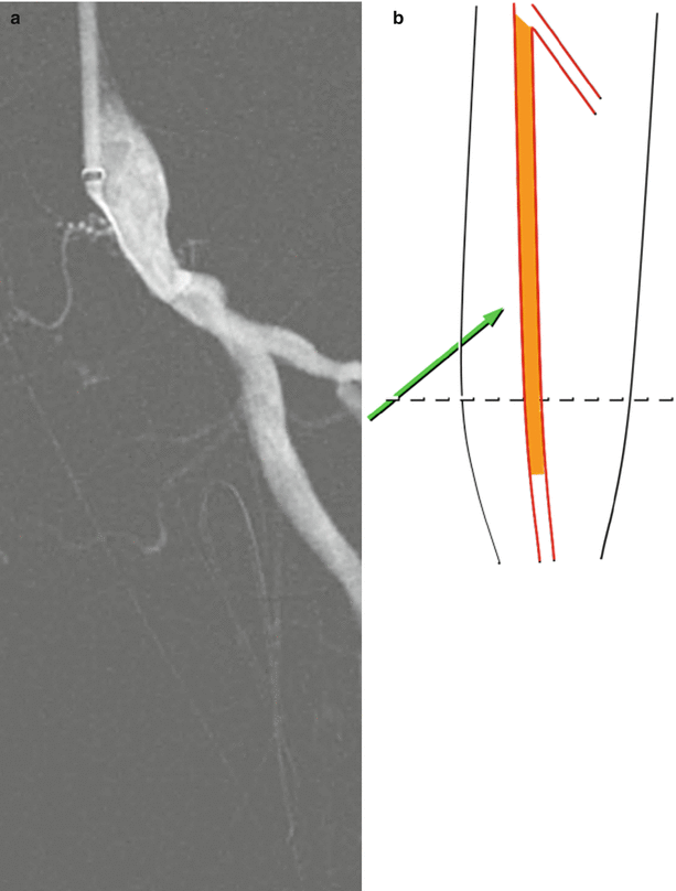 Distal Superficial Femoral Artery (SFA) Access | SpringerLink