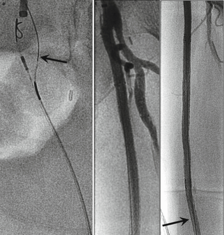 Distal Superficial Femoral Artery (SFA) Access | SpringerLink