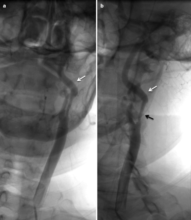 Percutaneous Carotid Interventions with a Difficult Aortic Arch ...