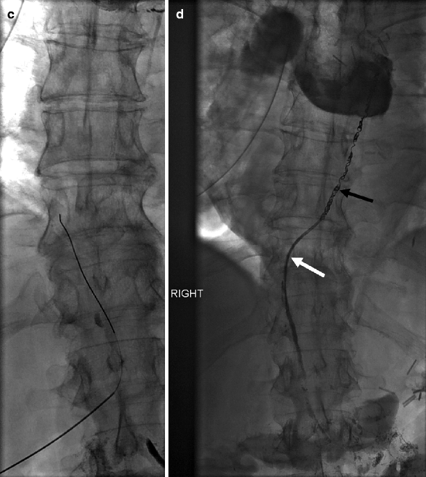 Thoracic Duct Embolization: Technique and Applications | SpringerLink