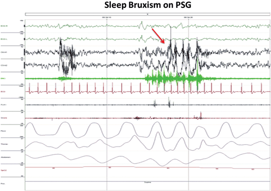 Sleep Bruxism | SpringerLink