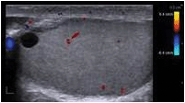 Scrotal Ultrasound | SpringerLink