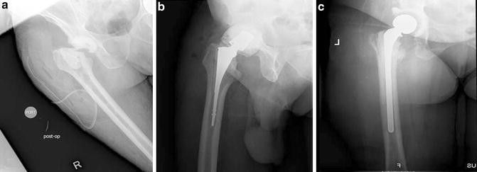 Two-Stage Exchange Hip Arthroplasty: Articulating Spacers | SpringerLink