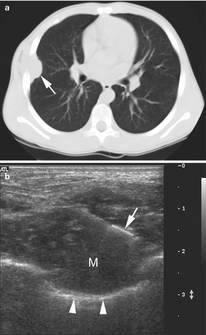 Pleural Biopsy | SpringerLink