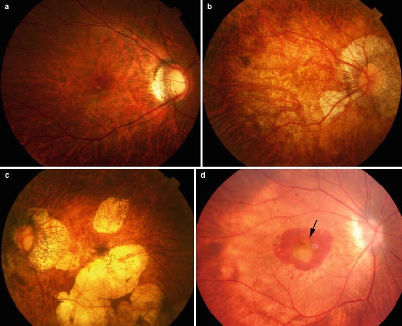 Myopic Chorioretinal Atrophy | SpringerLink