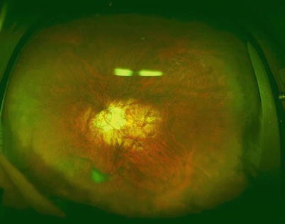 Myopic Chorioretinal Atrophy | SpringerLink