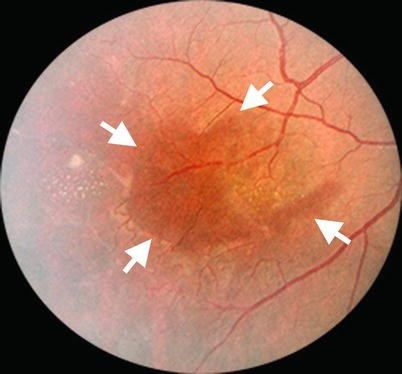 Peripheral Retinal Abnormalities | SpringerLink