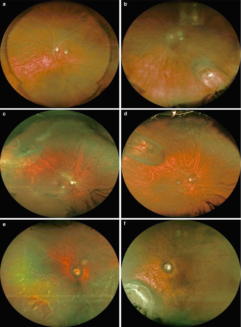 Peripheral Retinal Abnormalities | SpringerLink