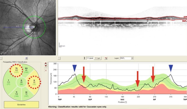 Glaucoma in Myopia | SpringerLink