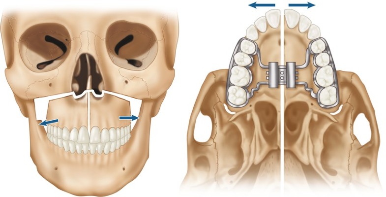 Maxillary Osteotomies | SpringerLink