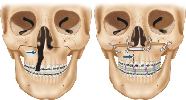 Maxillary Osteotomies | SpringerLink