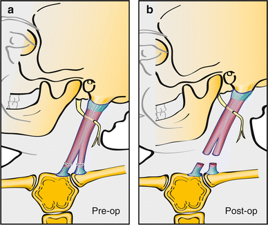 Torticollis and Sprengel’s Deformity | SpringerLink