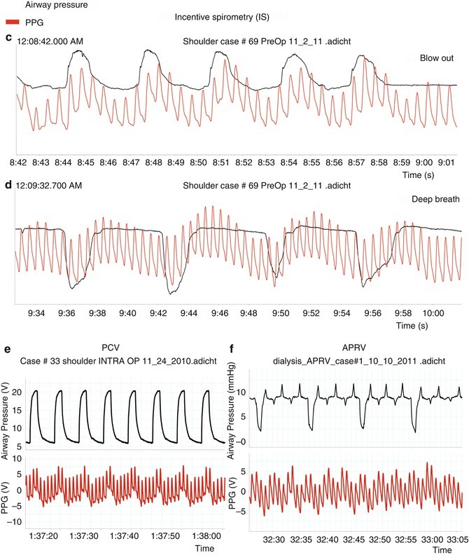 Photoplethysmography: Analysis of the Pulse Oximeter Waveform ...