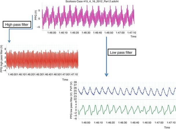 Photoplethysmography: Analysis of the Pulse Oximeter Waveform | SpringerLink
