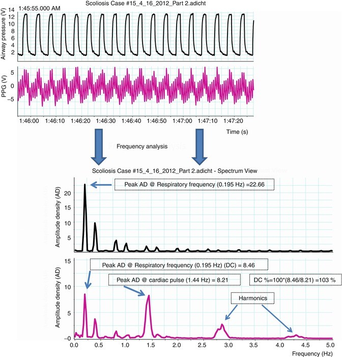 Photoplethysmography: Analysis of the Pulse Oximeter Waveform ...