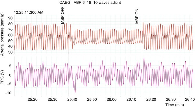 Photoplethysmography: Analysis of the Pulse Oximeter Waveform ...