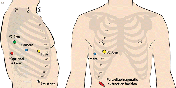 Complete Port-Access Robotic-Assisted Lobectomy Utilizing Three-Arm ...
