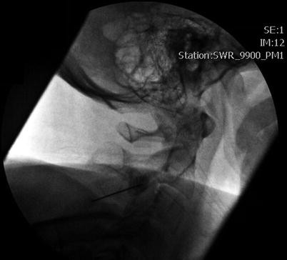 Third Occipital Nerve Block and Radiofrequency Ablation | SpringerLink