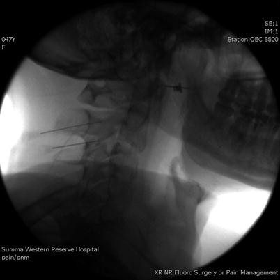 Third Occipital Nerve Block and Radiofrequency Ablation | SpringerLink