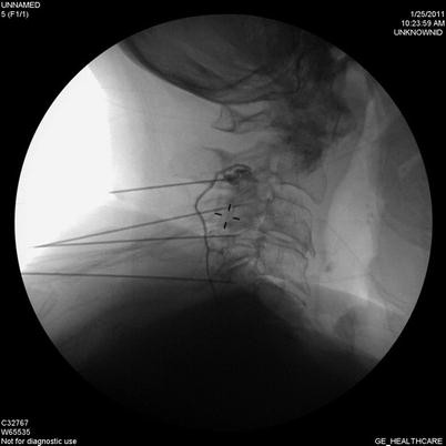 Cervical Facet Syndrome: Cervical Medial Branch Block and ...