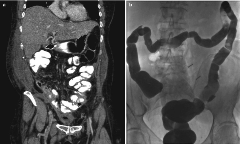Enterocutaneous Fistulas | SpringerLink