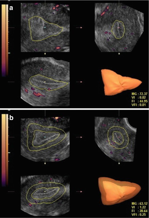 Ultrasound in Follicle Monitoring for Ovulation Induction/IUI ...