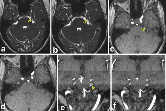 Vascular Loop Syndromes | SpringerLink