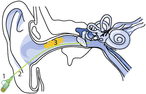 Focal Drug Delivery in Inner Ear Therapy | SpringerLink