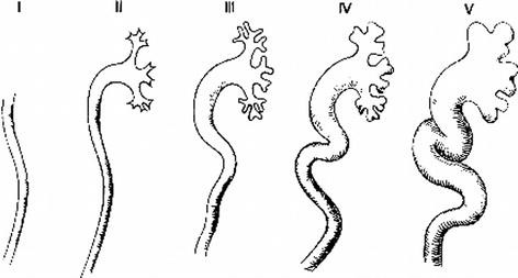 Vesicoureteral Reflux and Radionuclide Cystography | SpringerLink