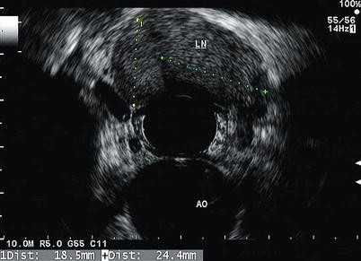 Endoscopic Ultrasound in the Upper Gastrointestinal Tract | SpringerLink