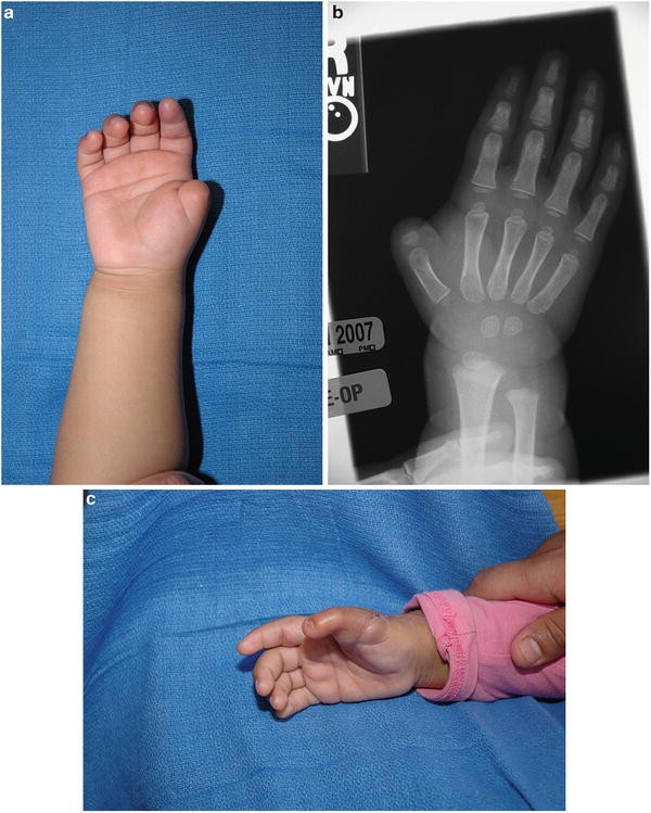 Symbrachydactyly | SpringerLink