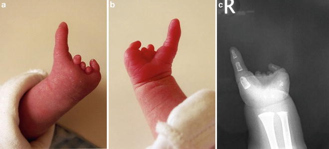 Symbrachydactyly | SpringerLink