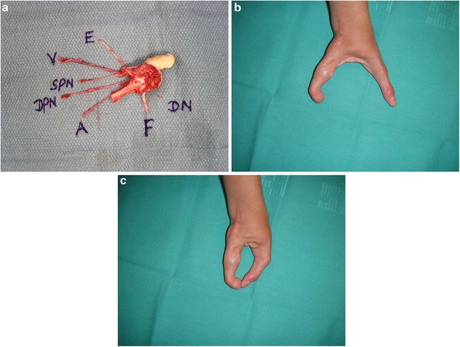 Symbrachydactyly | SpringerLink