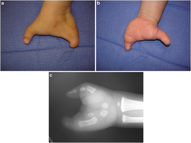 Symbrachydactyly | SpringerLink