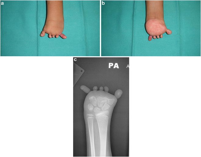 Symbrachydactyly | SpringerLink