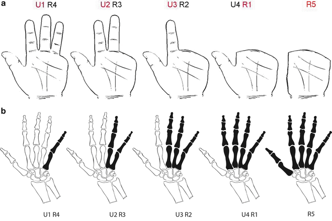 Symbrachydactyly | SpringerLink
