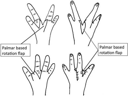 Central Deficiency (Cleft Hand) | SpringerLink