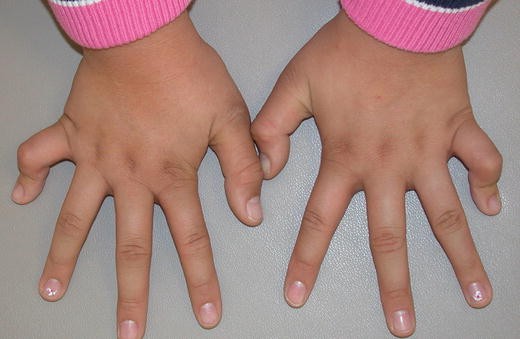 Camptodactyly and Clinodactyly | SpringerLink