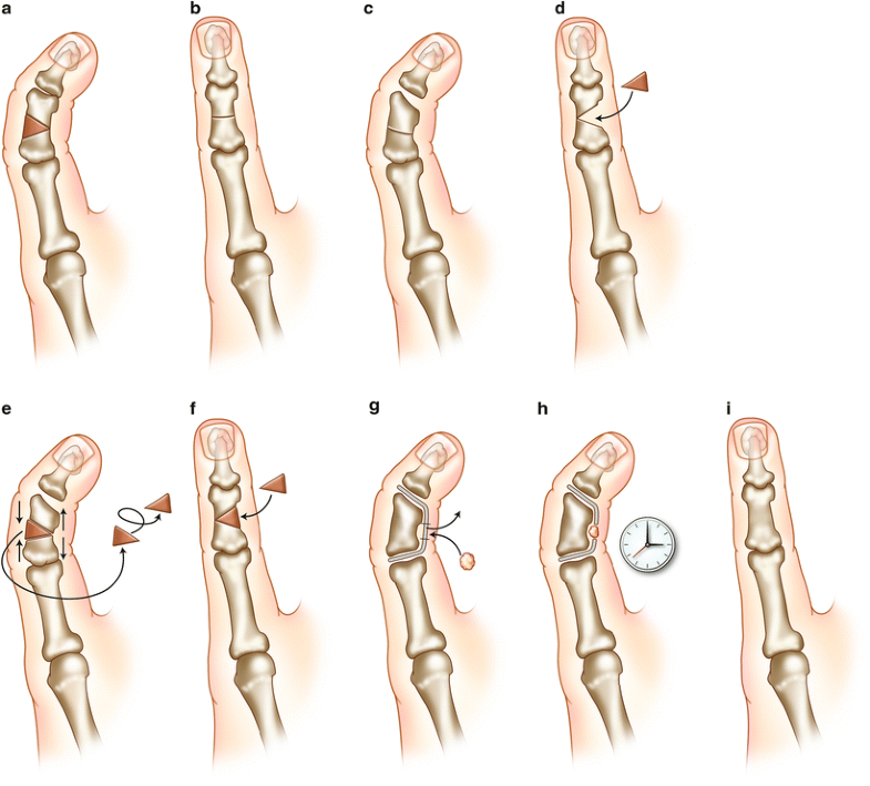 Camptodactyly and Clinodactyly | SpringerLink