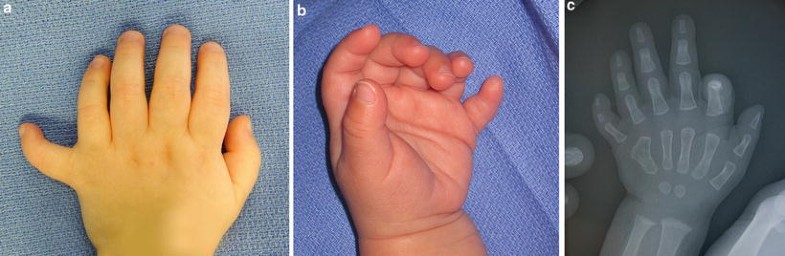 Ulnar Polydactyly and Ulnar Dimelia | SpringerLink