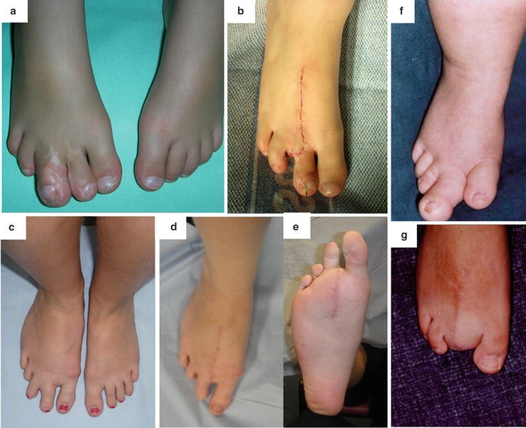 Macrodactyly | SpringerLink