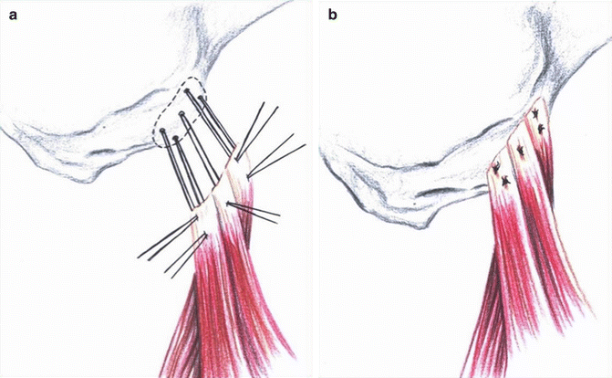 Acute Proximal Hamstring Tendon Avulsions | SpringerLink
