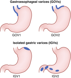 How to Manage Gastric and Ectopic Varices? | SpringerLink