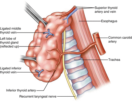 Thyroidectomy | SpringerLink