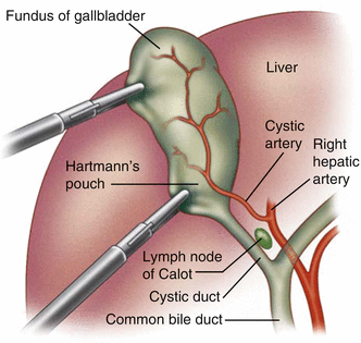 Cholecystectomy | SpringerLink