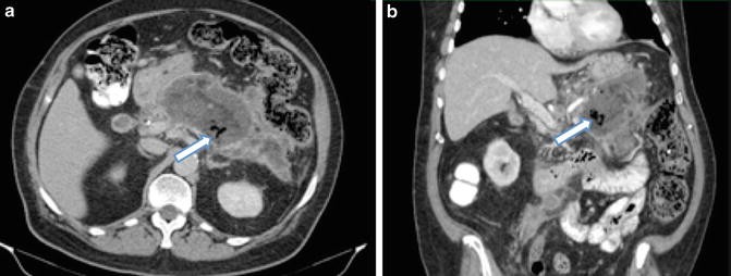 Sterile and Infected Pancreatic Necrosis | SpringerLink