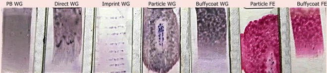 Peripheral Blood Smears, Bone Marrow Aspiration, Trephine and Clot ...