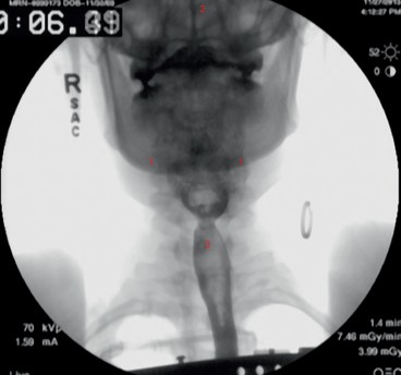 The Videofluoroscopic Swallow Study Technique and Protocol | SpringerLink